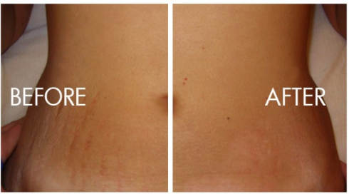 Rundown On Stretch Marks Treatment | Health & Beauty Services Baton ...