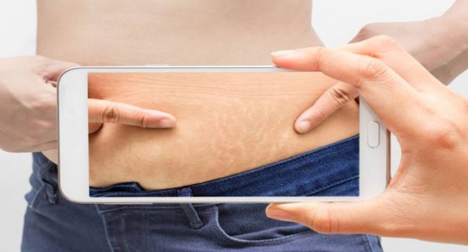 Rundown On Stretch Marks Treatment | Health & Beauty Services Baton ...