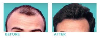 Hair Restoration Therapy - PRP Therapy for Hair Loss Baton Rouge — MetaGlow